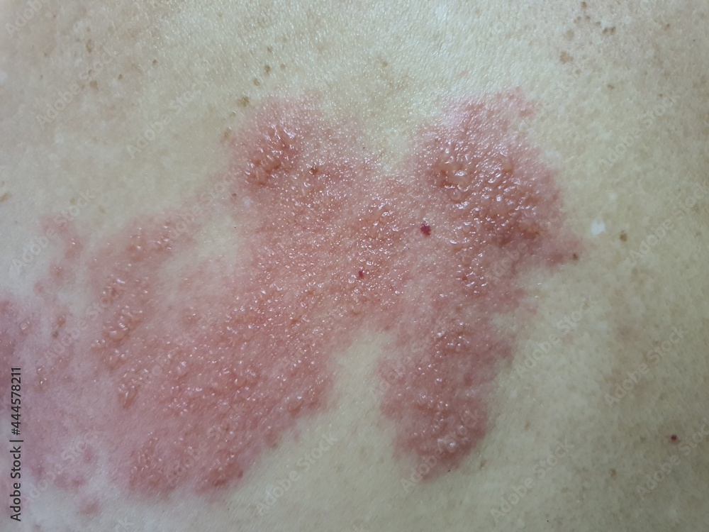 Herpes Zoster, Shingles are caused by a virus. varicella-zoster virus ...