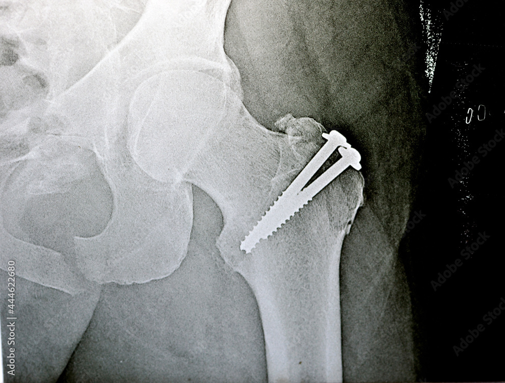Selective focus of a plain x ray on left hip joined with a fracture of ...