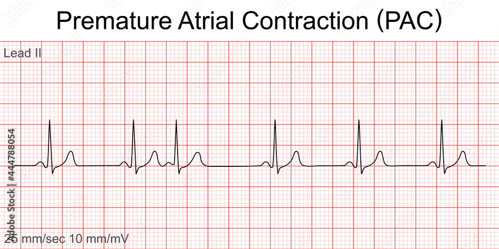 Electrocardiogram show Premature Atrial Contraction (PAC) pattern ...