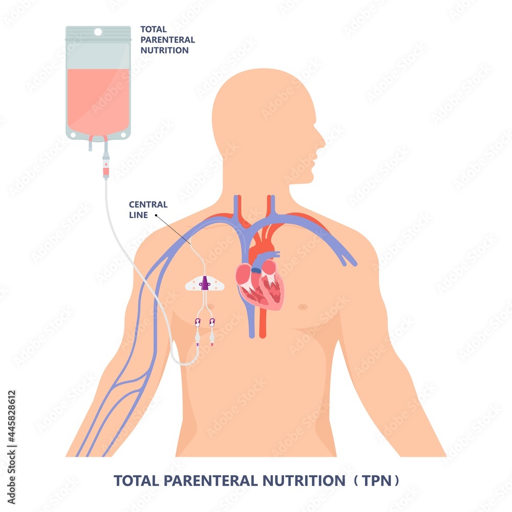 TPN PPN Total tube nutritional partial line PICC IV care unit ICU tract ...