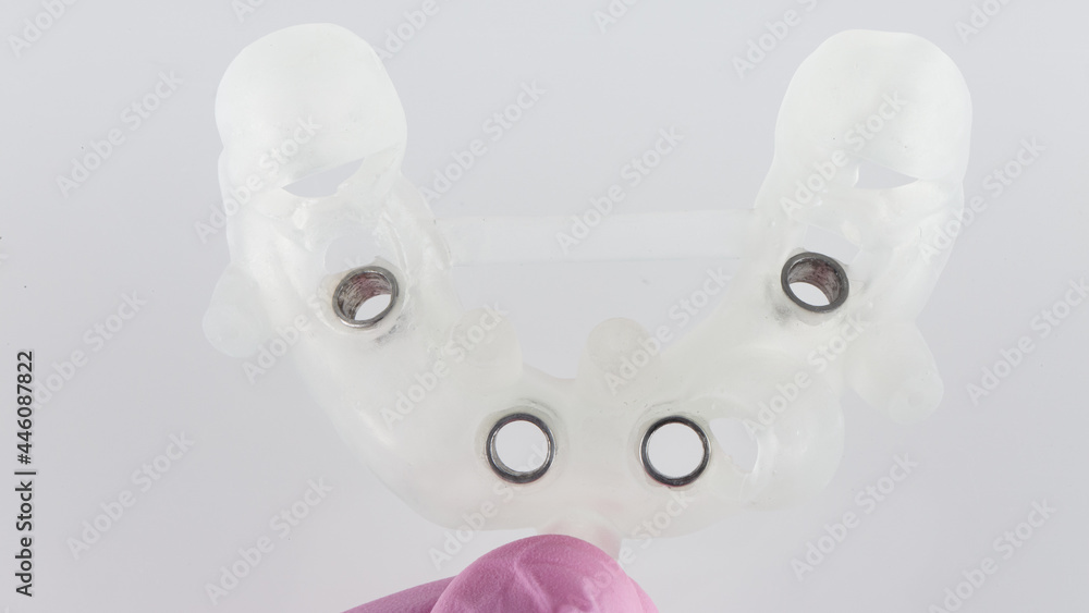 classic surgical template for implantation of four implants for the ...