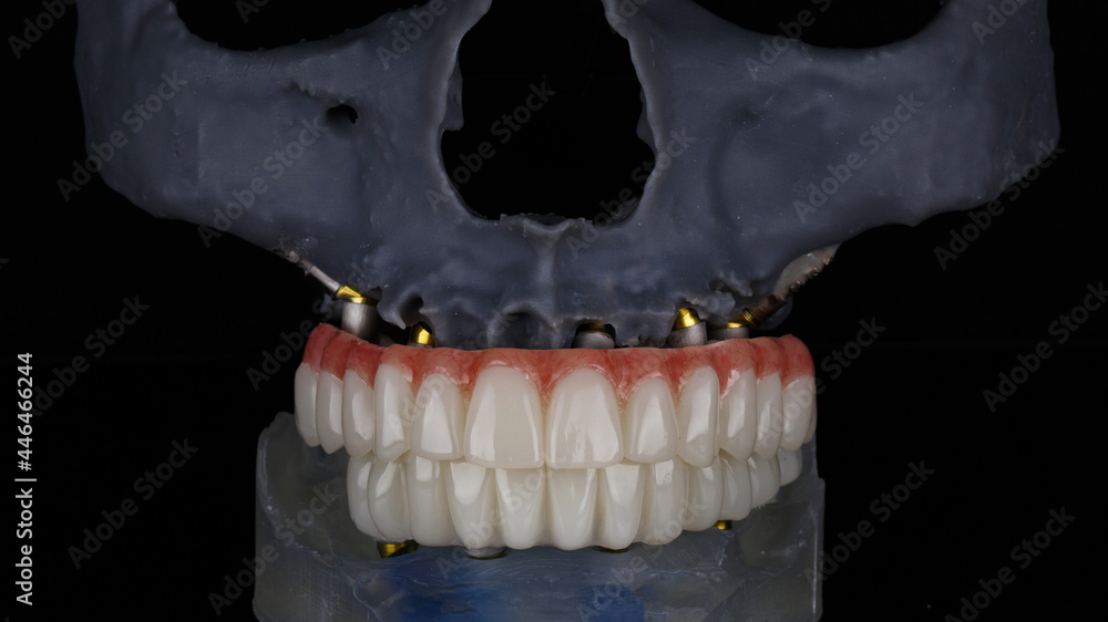 dental model of the skull and prosthesis of the upper and lower jaws in ...