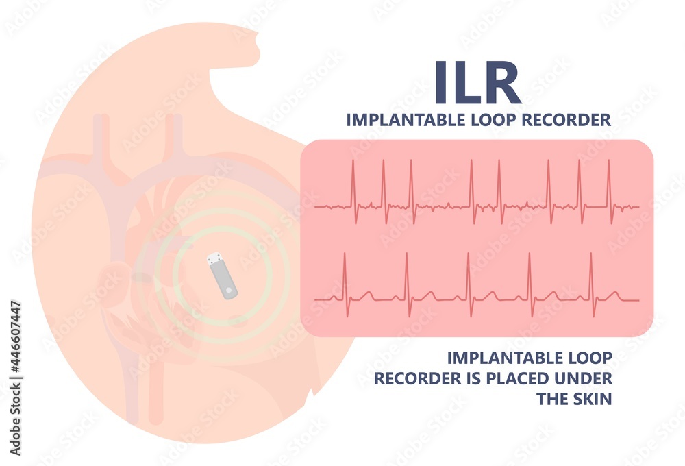 เวกเตอร์ Stock loop holter event atrial heart attack stroke ECG EKG ...