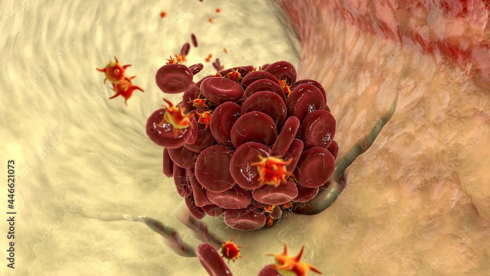 Blood clot in damaged blood vessel made of red blood cells, platelets ...