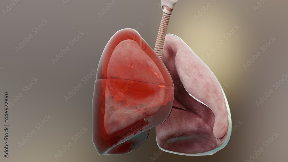 3d Illustration of Hemothorax, Normal lung versus collapsed, symptoms ...