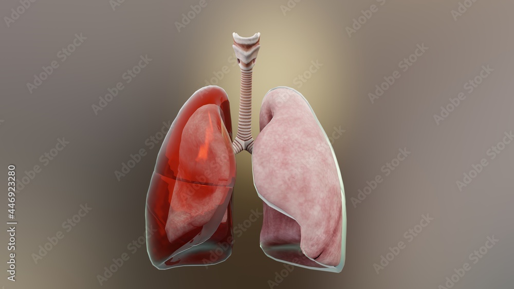 3d Illustration of Hemothorax, Normal lung versus collapsed, symptoms ...