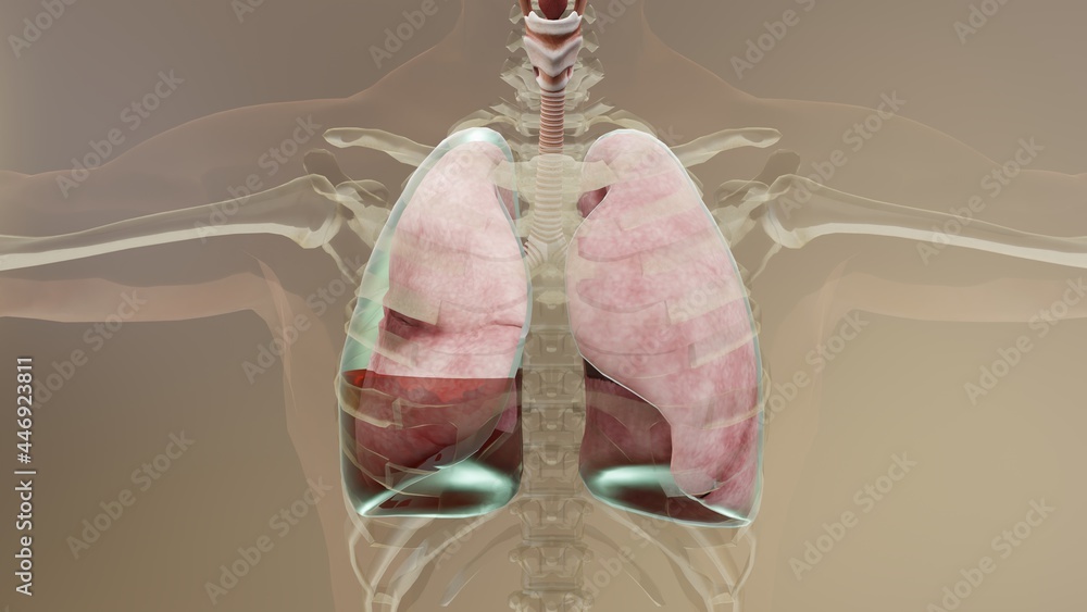 3d Illustration of Hemopneumothorax, Normal lung versus collapsed ...