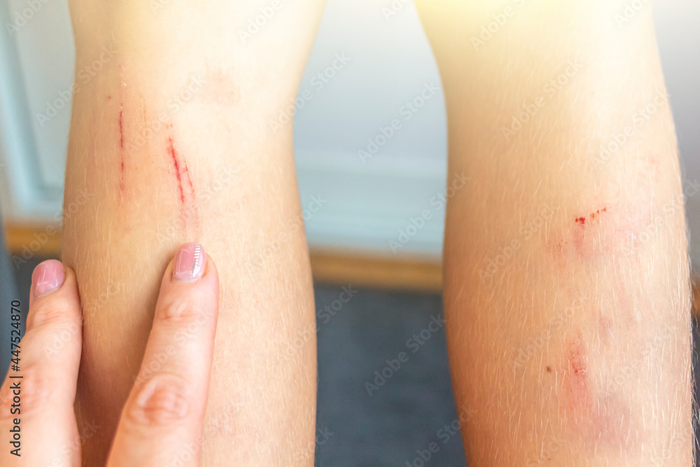 Leg of child with bruise (injury). Pain, hematoma, first aid ...