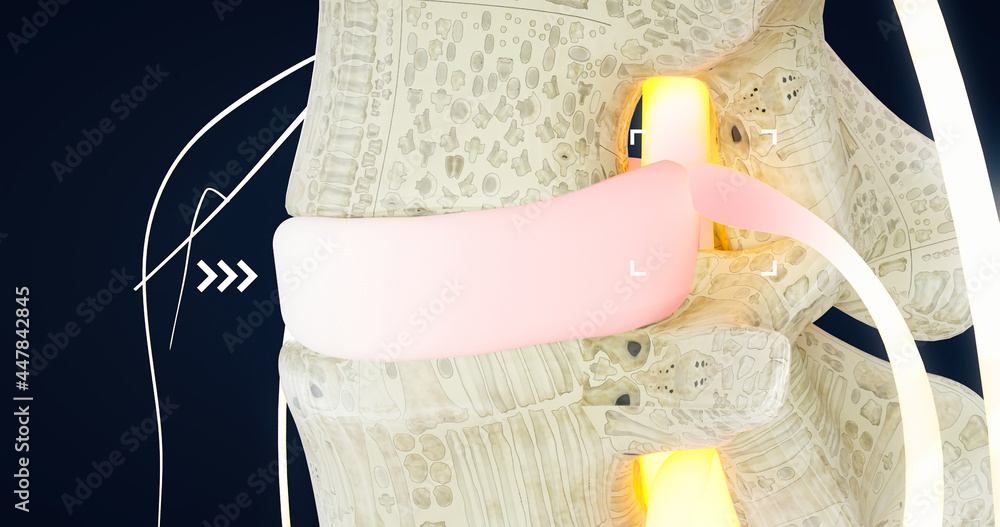 Protrusion of intervertebral discs, formation of a spinal hernia ...