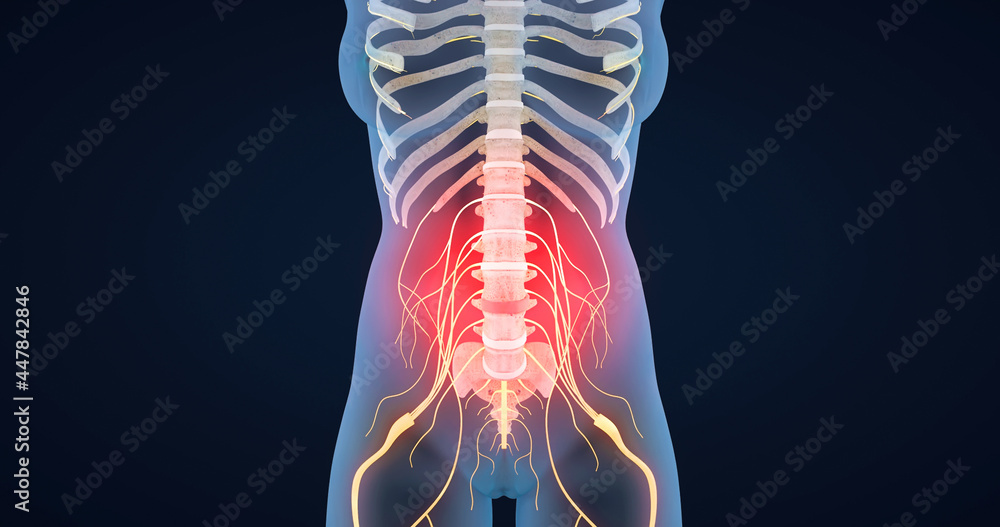 Stock-Illustration „Protrusion of intervertebral discs, formation of a ...