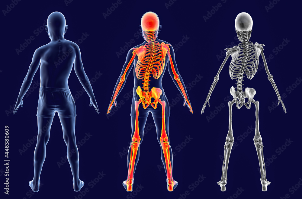 Scoliosis, 3D illustration. A human body with curved spine, uneven ...