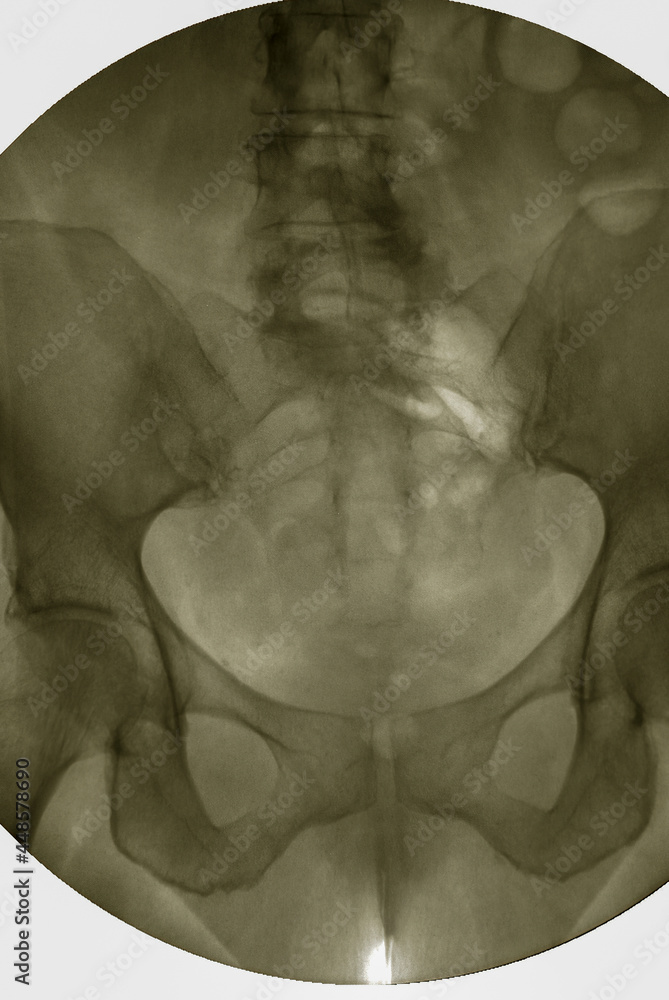 Barium enema image or colorectal x-ray view showing anatomical of large ...