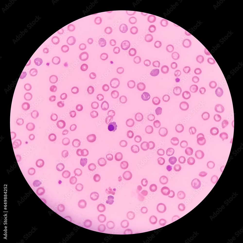 Fotografie Under a microscope show the red blood cells have less color ...