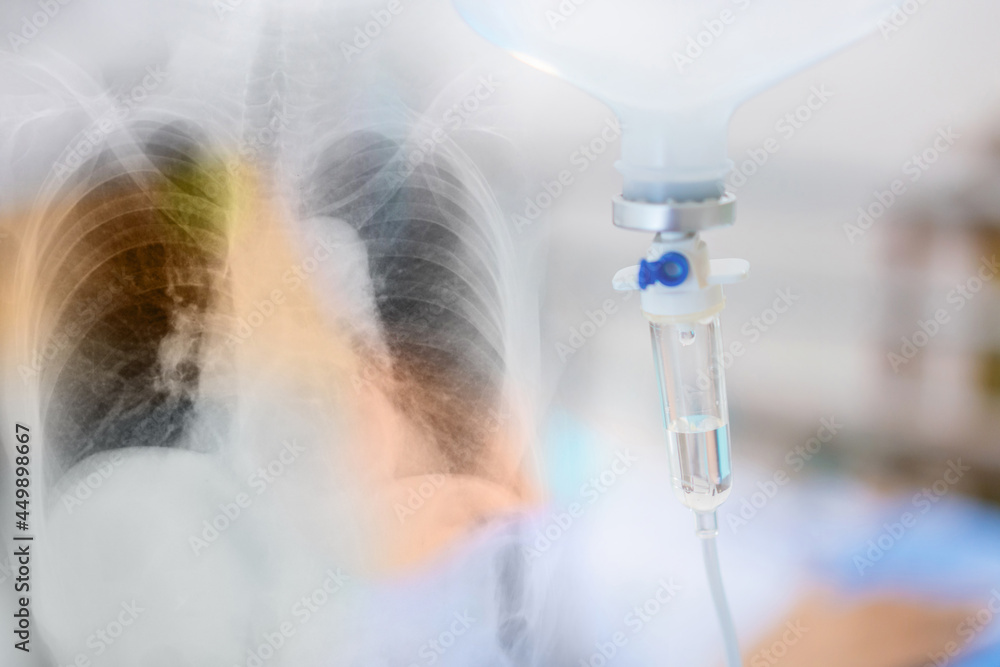 X-Ray Image of human lungs for a medical coronavirus covid-19 diagnosis ...