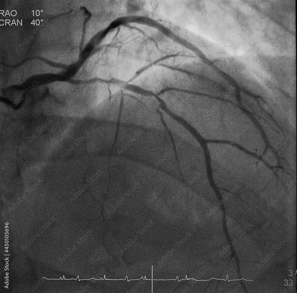 coronary angiogram (CAG) was performed mid part of left anterior ...