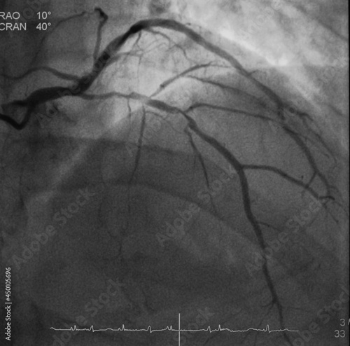 coronary angiogram (CAG) was performed mid part of left anterior ...
