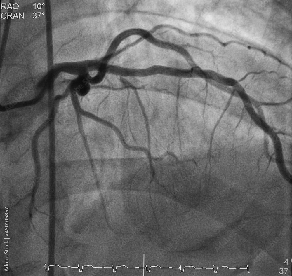 coronary angiogram (CAG) was showed normal left coronary artery (LCA ...