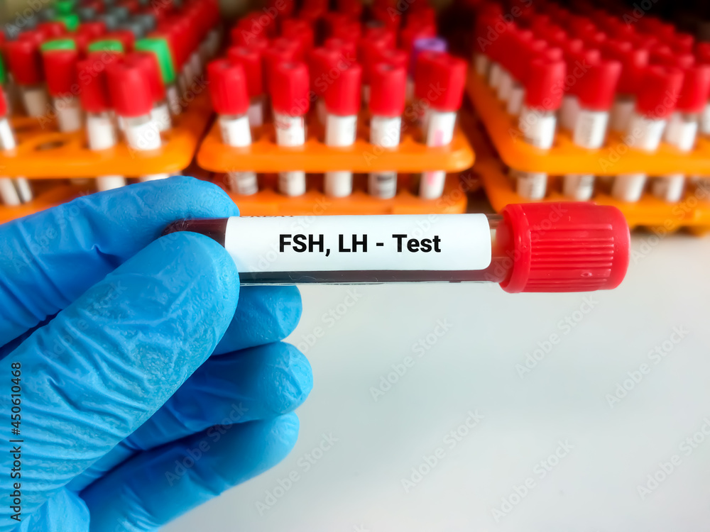 Blood sample tube for FSH, LH (Follicle Stimulating Hormone ...