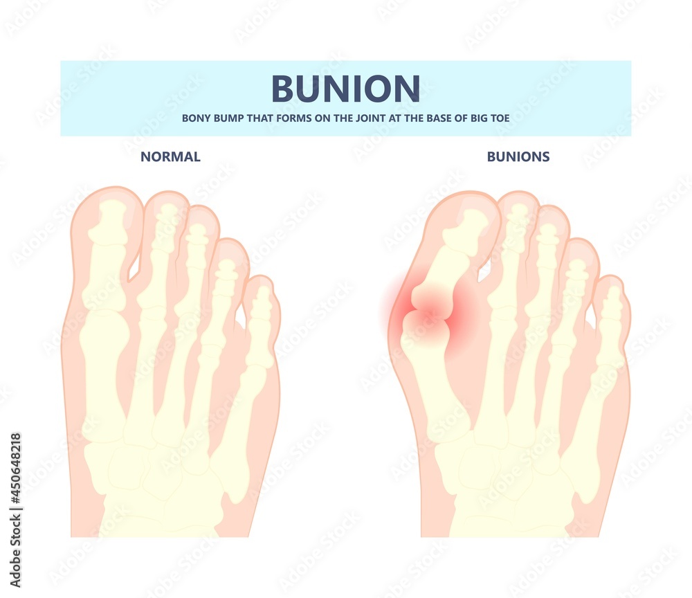 bony bump joint big toe bone enlarge fifth foot pain shoe Tailor ...