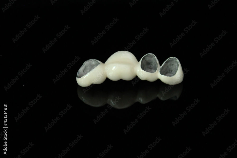 Dental PFM crown and bridge with all porcelain baked for new smile ...