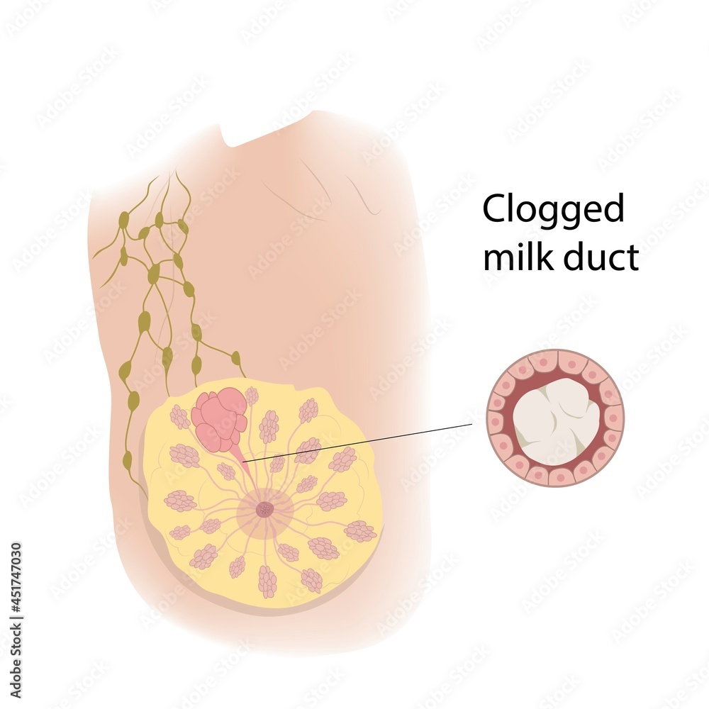 Clogged milk duct, illustration Stock Illustration | Adobe Stock