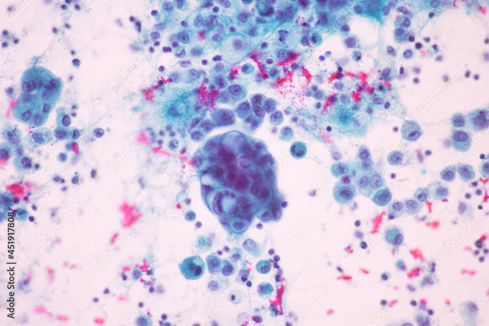Stock-Foto „View in microscopic of Abnormal human cervix cells.Squamous ...