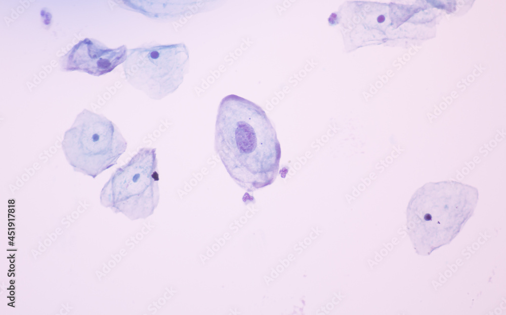View in microscopic of Abnormal human cervix cells.Squamous epithelium ...
