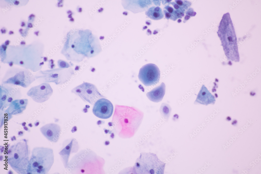 View in microscopic of Abnormal human cervix cells.Squamous epithelium ...