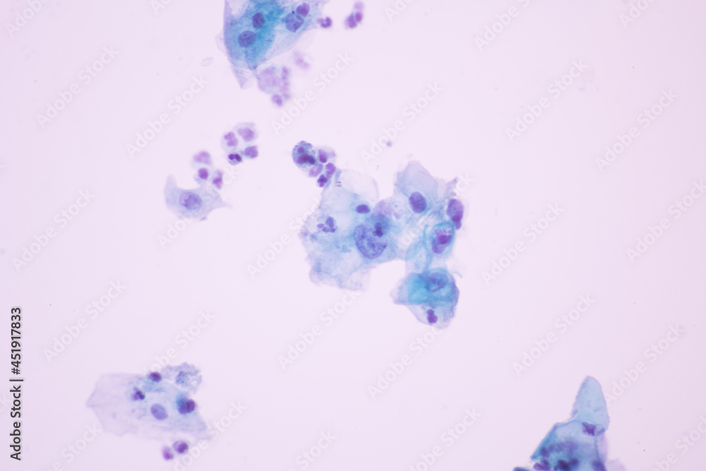 View in microscopic of Abnormal human cervix cells.Squamous epithelium ...