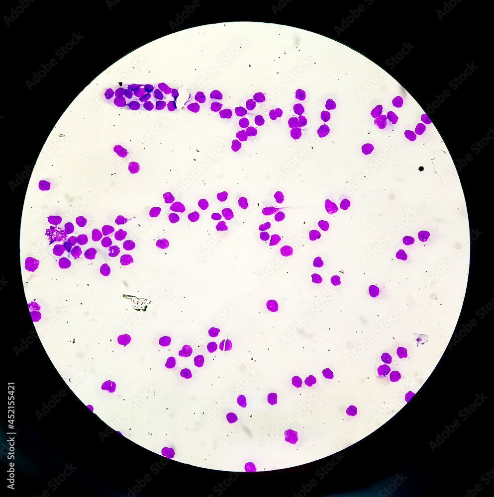 Blood smear under microscopy showing on Adult acute myeloid leukemia ...