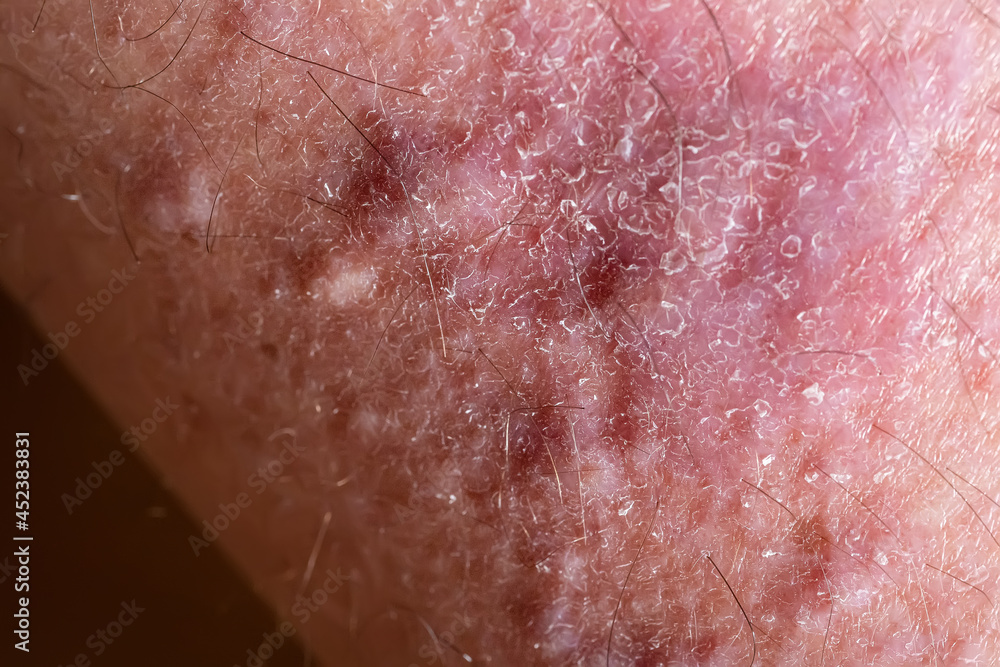 Lichen planus on leg skin close-up. Dermatological disease in form of ...
