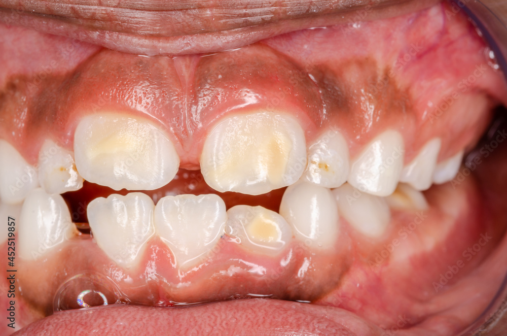 Molar incisor hypomineralization Stock Photo | Adobe Stock