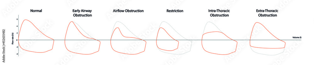 Spirometry test. Different loop of abnormal ventilatory function. Stock ...