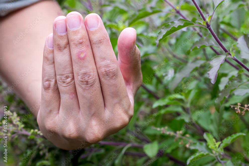 Paronychia, swollen finger inflammation due to bacterial infection on a ...