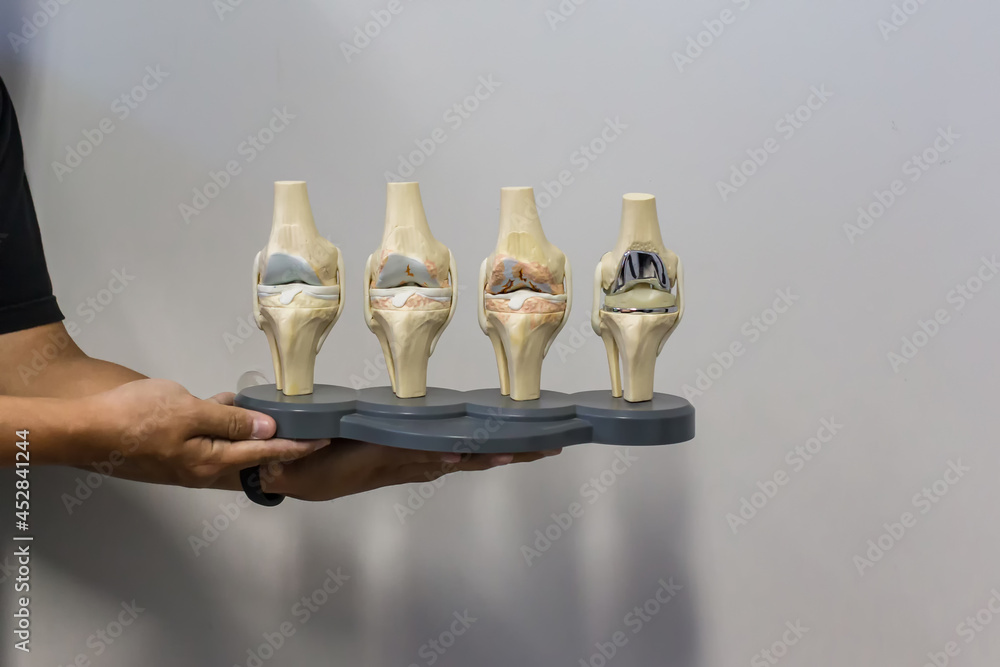 Doctor show anatomical model of knee displaying progression of knee ...