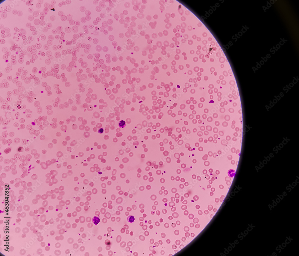 Microscopic image of Immune-hemolytic anemia, It's immune system attack ...