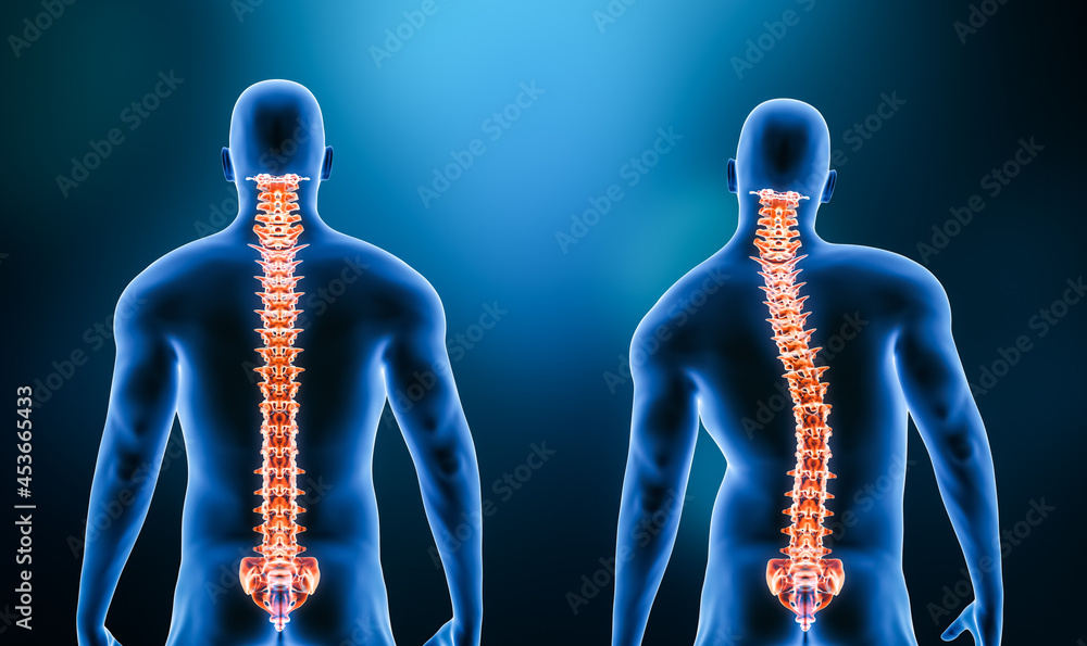Comparison between normal backbone and scoliosis curvature of the spine ...