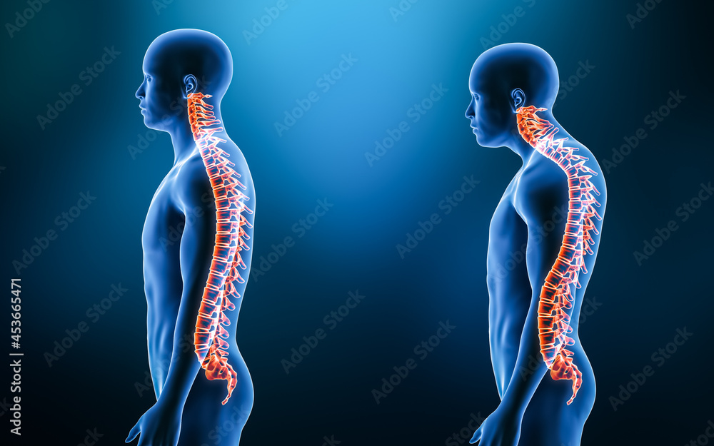 Ilustración de Stock Comparison between normal curvature of the spine ...