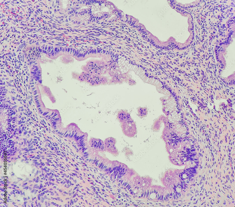 Camera photo of adenocarcinoma in situ (AIS) of cervix, magnification ...