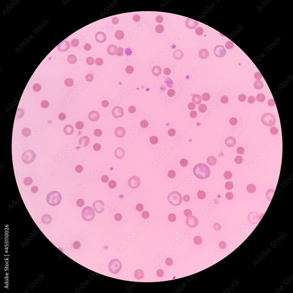 Polychromasia and spherocytosis seen in a peripheral blood smear from a ...