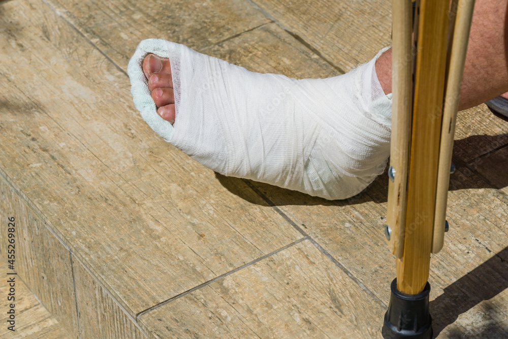 Man with broken leg in white plaster cast go down steps with crutches ...