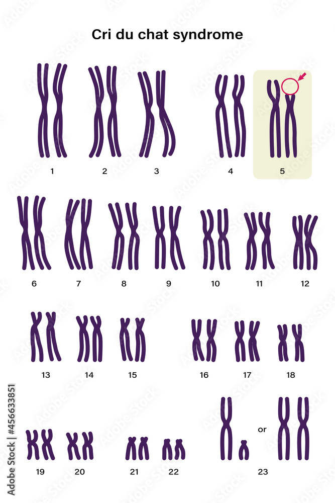 Human karyotype of Cri du chat syndrome. Autosomal abnormalities. A ...