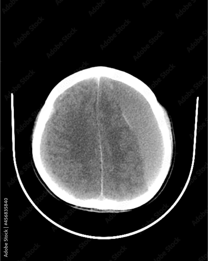 Brain ct scan of epidural hemorrhage Stock Photo | Adobe Stock
