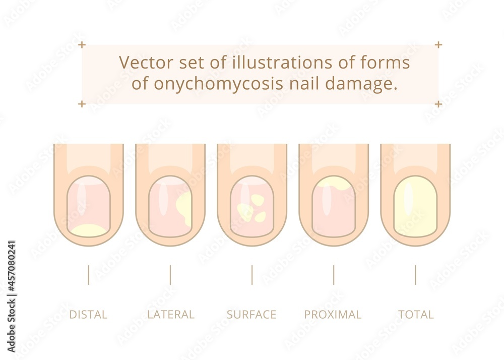 Vector set of illustrations of forms of onychomycosis nail damage ...