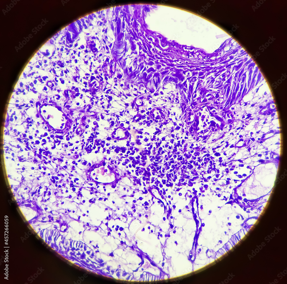 Cancer of Esophagus: Poorly differentiated adenocarcinoma in a patient ...