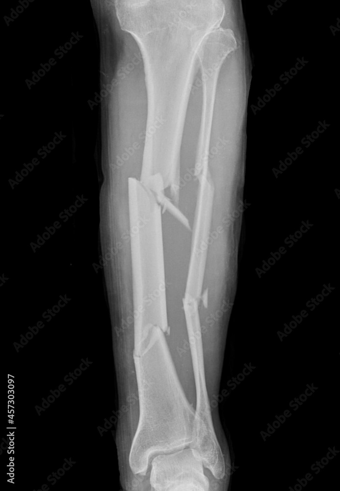 x ray of cruris segmented fracture Stock Photo | Adobe Stock