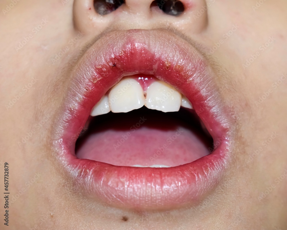 Angular stomatitis or angular cheilitis or perleche in asian little boy ...
