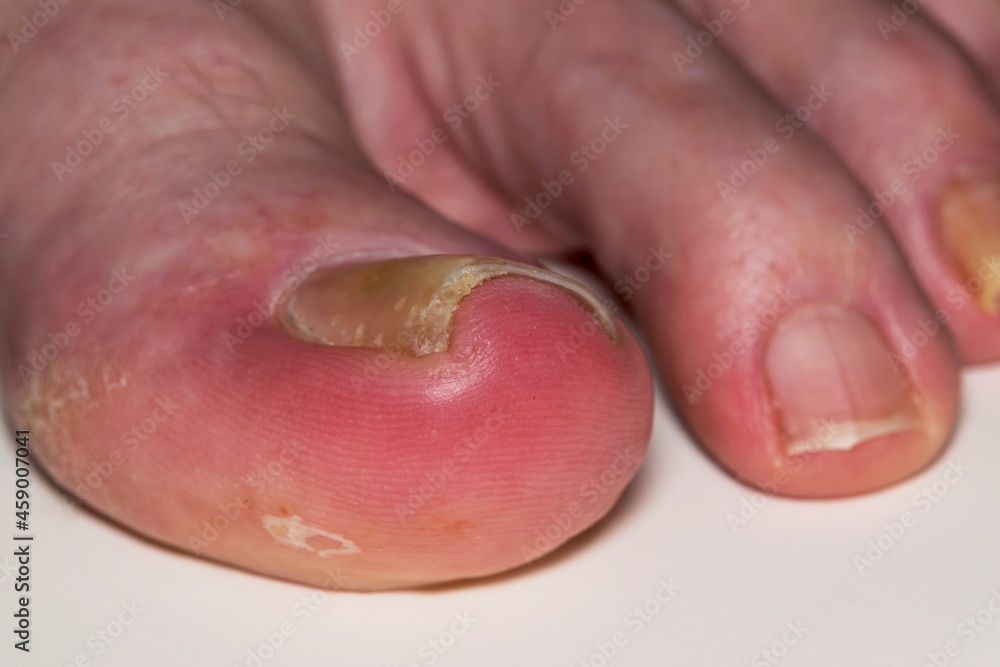 Ingrown toenail onychocryptosis on caucasian big toe Hallux, fungal ...