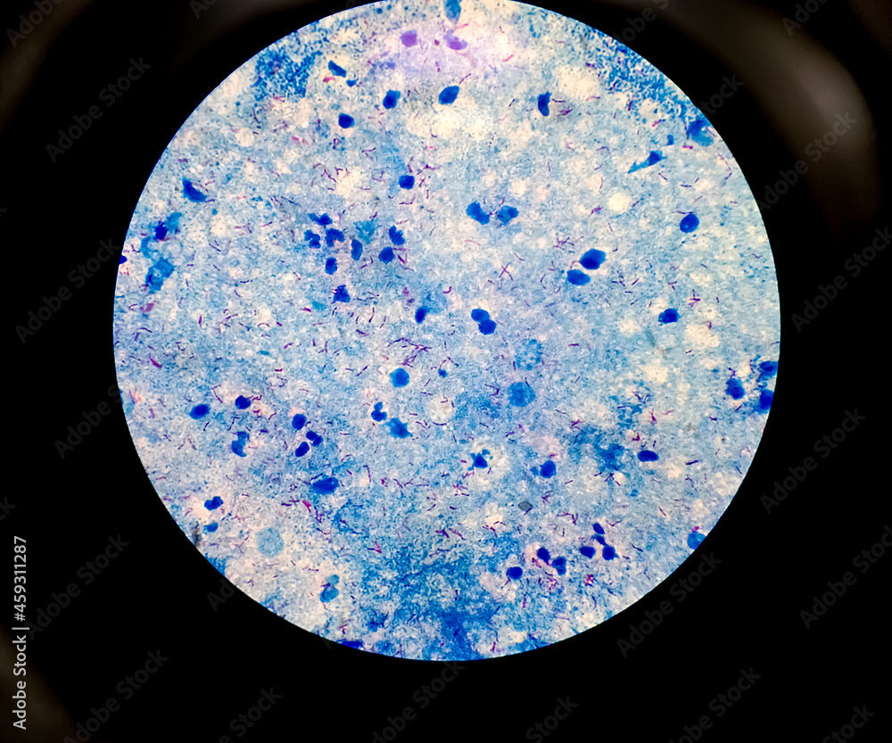 Pulmonary Tuberculosis ( TB ) : Sputum AFB stain microscopic image. To diagnosis mycobacterium ...