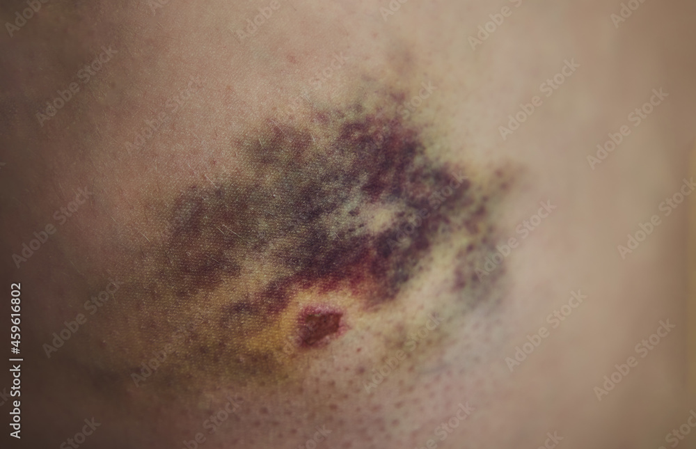 Trauma on a skin after an accident. Haematoma recovery process. Inner ...